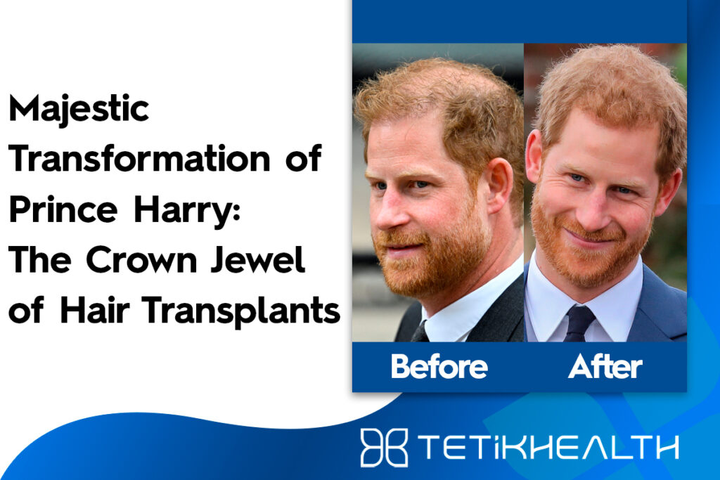 MAJESTIC TRANSFORMATION OF PRINCE HARRY: The Crown Jewel of Hair ...