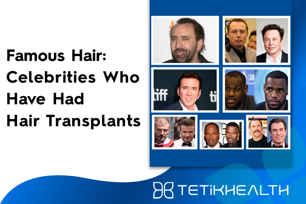 Famous Hair: Celebrities who Have Had Hair Transplants - Tetik Health